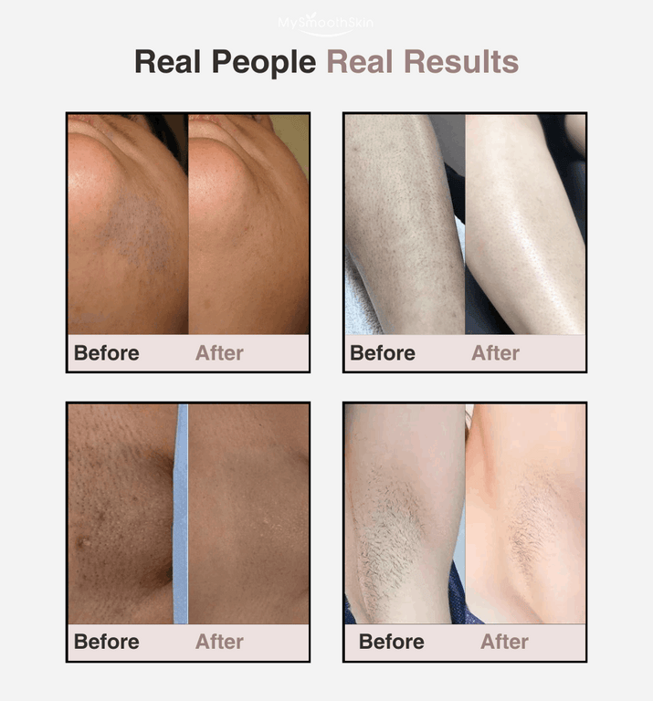 Portable At-Home IPL Laser Hair Removal Handset | MySmoothSkin